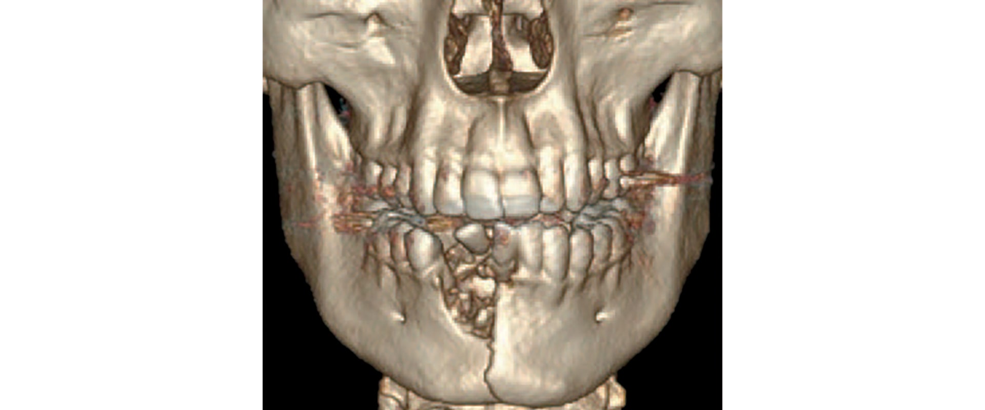 Why do vaporizers explode?